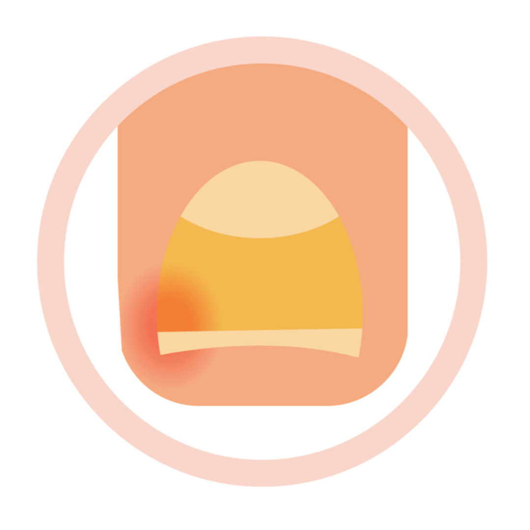 Ingrown Toenail Treatment